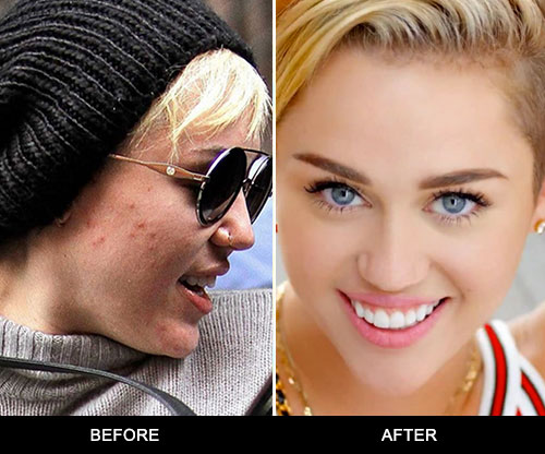 15 Gorgeous Celebrities That Suffered From Acne Outburst And You Had No ...