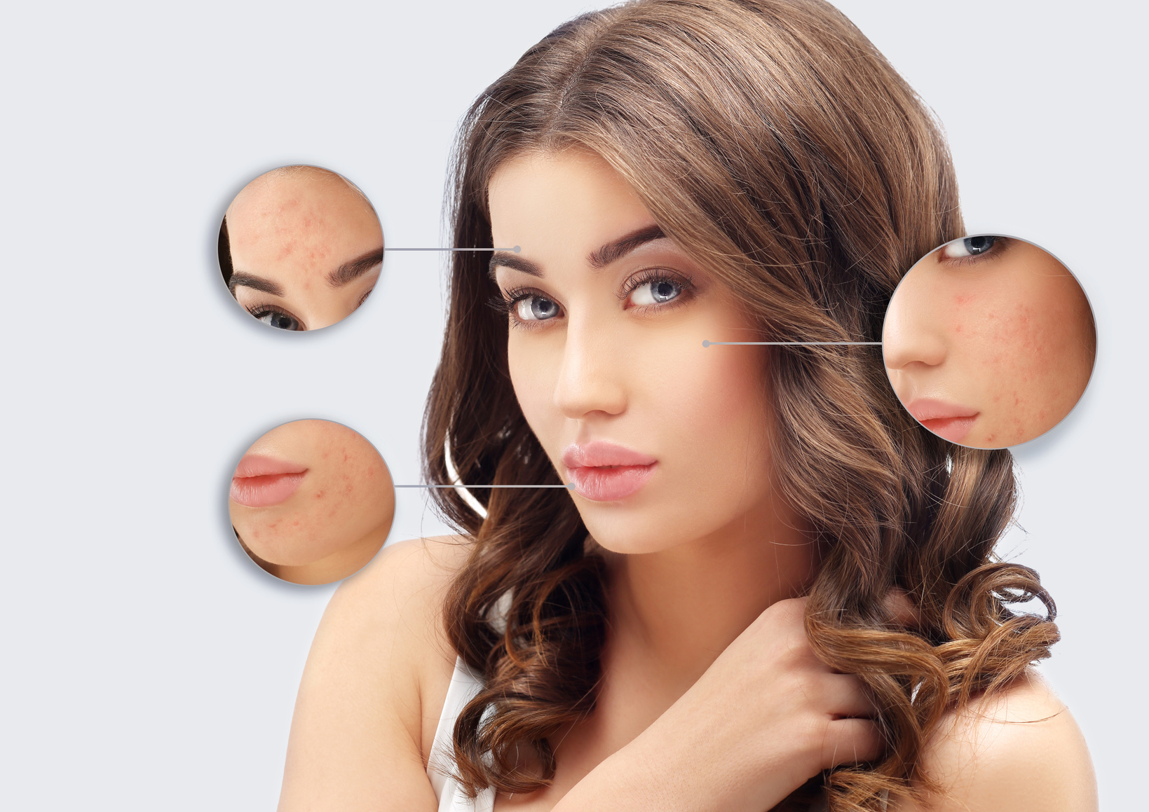 What Causes Pimple Marks And How To Treat Them Top Acne Treatments Review what-causes-pimple-marks-and-how-to-treat-them-top-acne-treatments-review