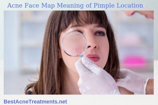 Acne Face Map: Meaning of Pimple Location - Top Acne Treatments Review